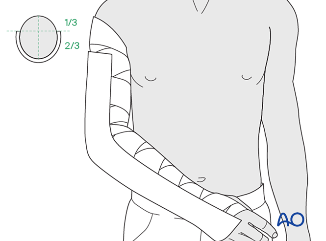 Splint immobilization for Extraarticular, simple oblique fracture