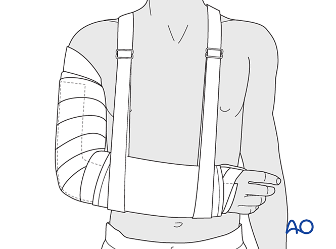 Splint immobilization for Avulsion of lateral epicondyle