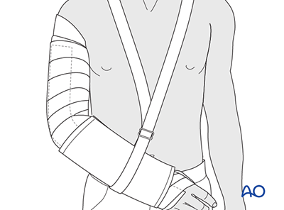 Splint immobilization for Extraarticular, simple oblique fracture