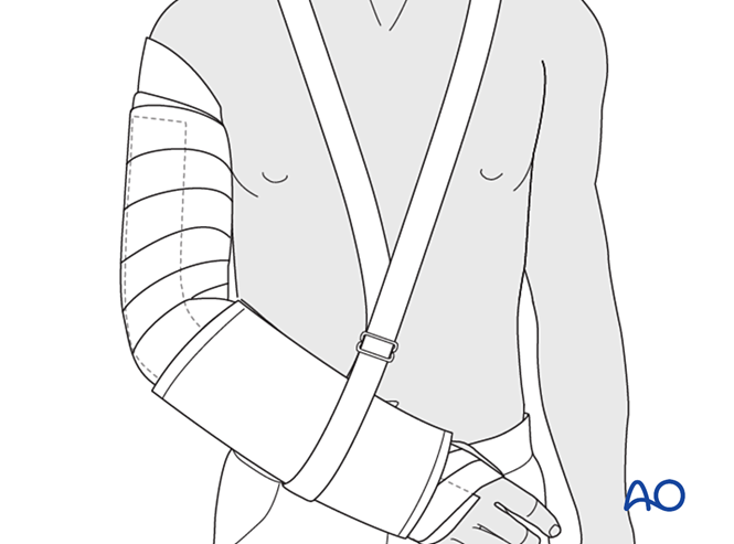 Splint immobilization for Extraarticular, simple oblique fracture