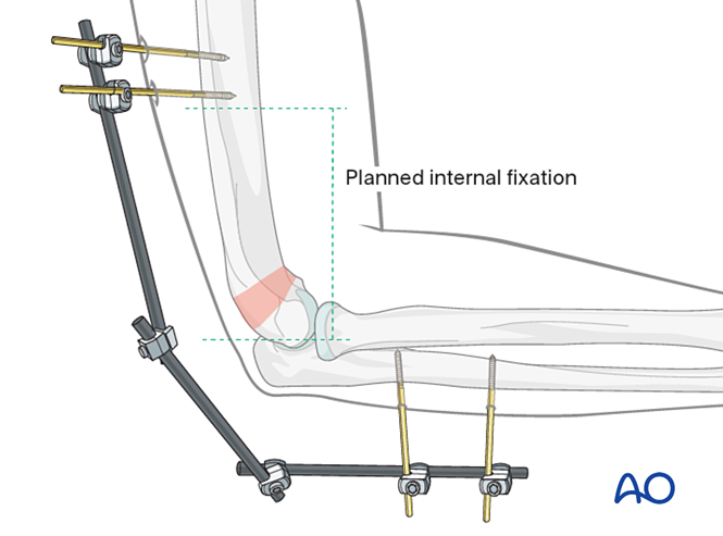 External fixation for Extraarticular, simple spiral fracture