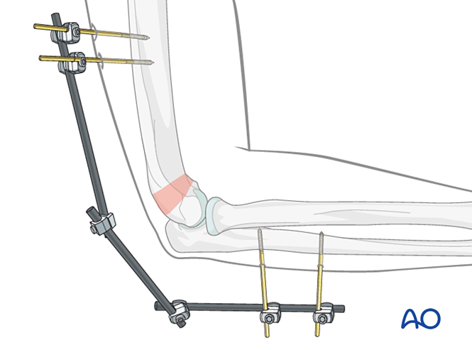 External fixation for Extraarticular, simple oblique fracture