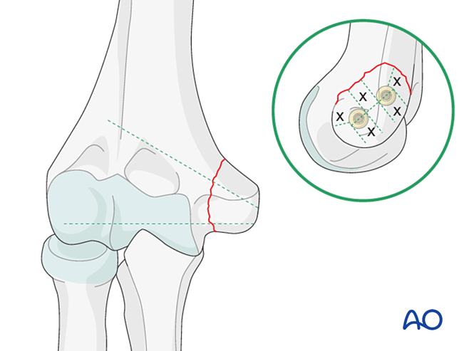 ORIF - Screw fixation for Avulsion of medial epicondyle