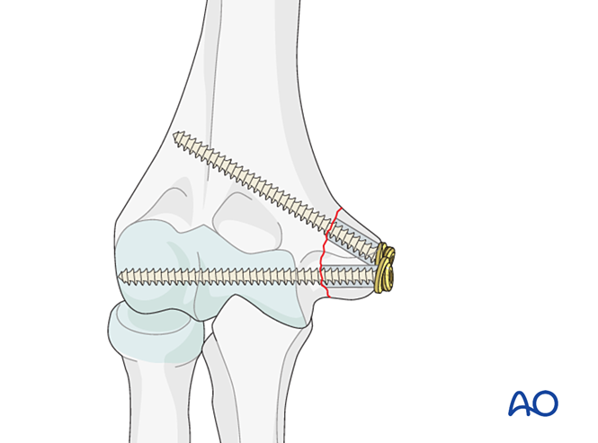 ORIF - Screw fixation for Avulsion of medial epicondyle