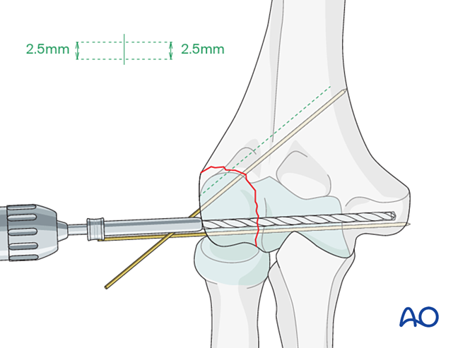 ORIF - Screw fixation for Partial articular, lateral sagittal fracture