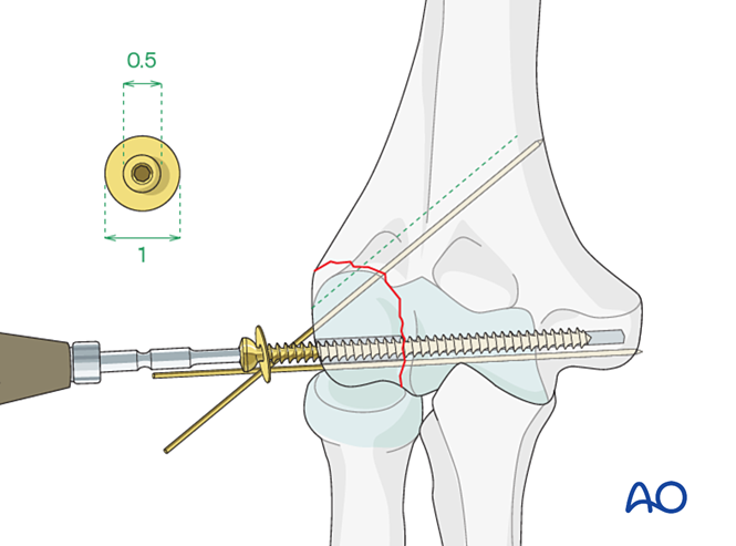 ORIF - Screw fixation for Partial articular, lateral sagittal fracture