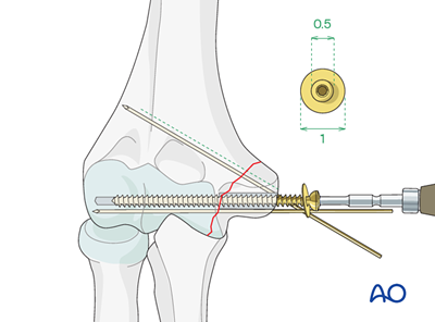 ORIF - Screw fixation for Partial articular, medial sagittal, simple ...