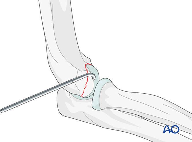 Orif Headless Screw Fixation For Partial Articular Fracture In