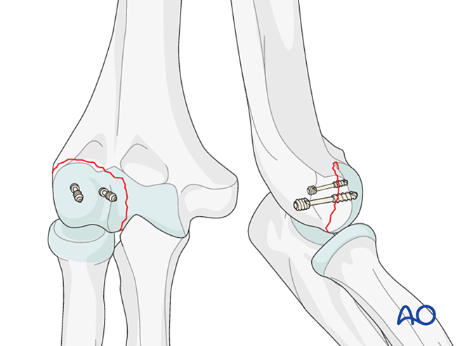 ORIF - Headless screw fixation for Partial articular fracture in ...