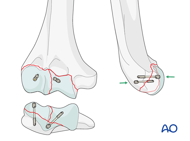 Orif Headless Screw Fixation For Partial Articular Fracture In