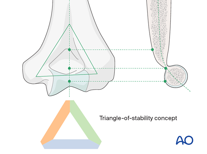 ORIF - Plate fixation for Extraarticular, multifragmentary fracture