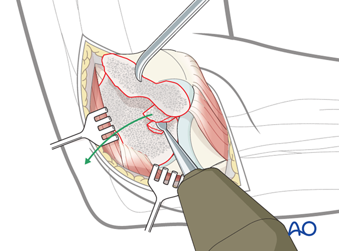 ORIF - Lag screw with antiglide plate for Partial articular, lateral ...
