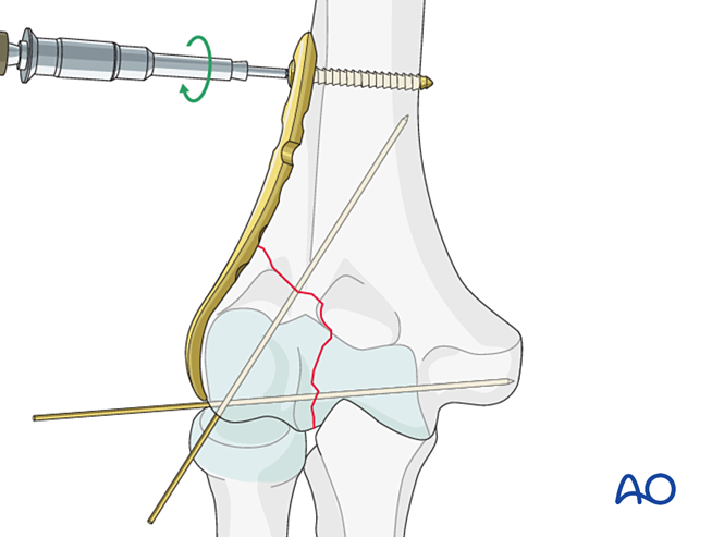 ORIF - Lag screw with antiglide plate for Partial articular, lateral ...