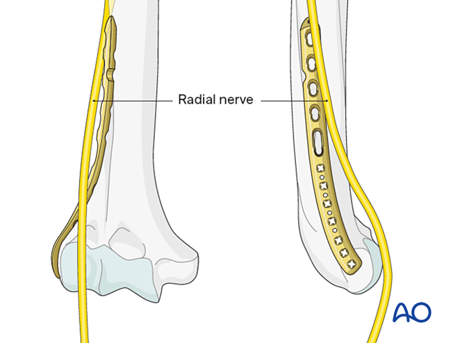 ORIF - Lag screw with antiglide plate for Partial articular, lateral ...