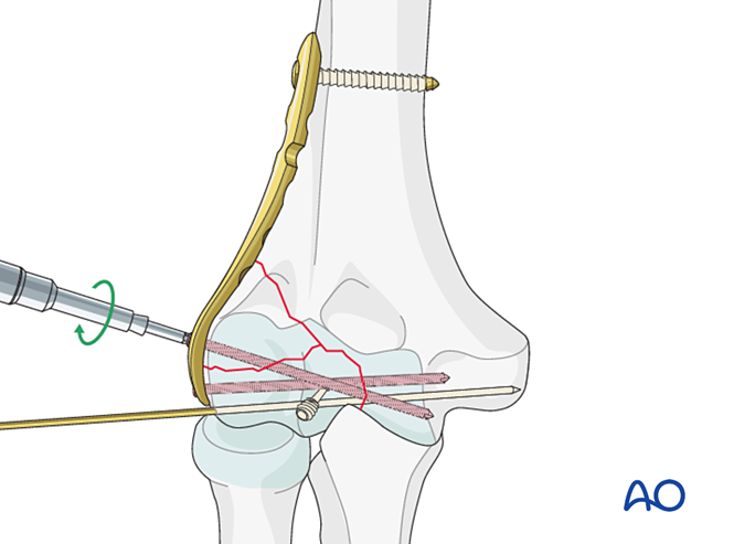 ORIF - Headless screw and plate fixation (simple osteochondral ...