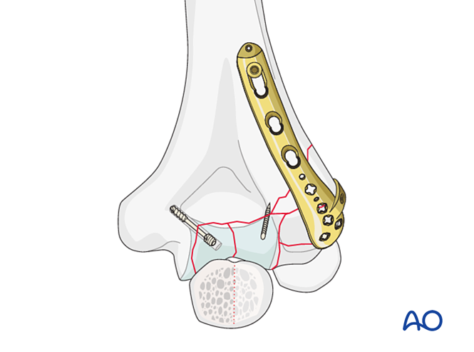 ORIF - Headless screw and plate fixation (complex osteochondral ...