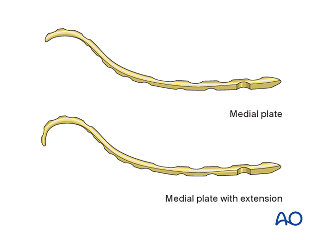 ORIF - Lag screw with antiglide plate for Partial articular, medial ...