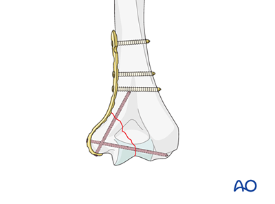 ORIF - Lag screw with antiglide plate for Partial articular, medial ...