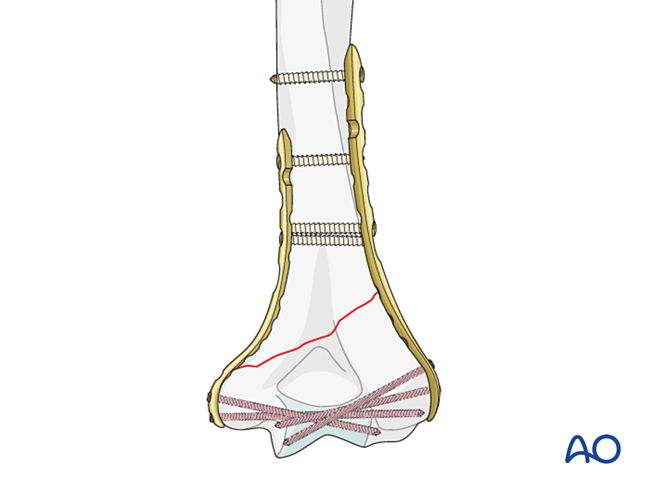 ORIF - Plate fixation with/without lag screw for Extraarticular, simple ...