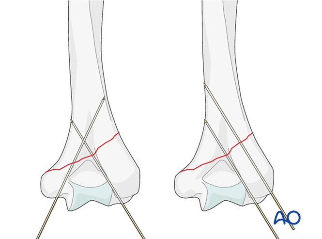 ORIF - Plate fixation with/without lag screw for Extraarticular, simple ...