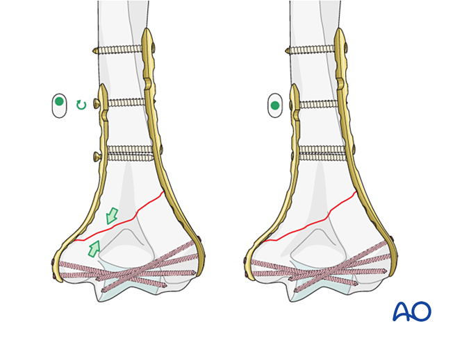 ORIF - Plate fixation with/without lag screw for Extraarticular, simple ...