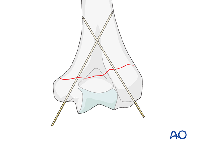 ORIF - Plate fixation for Extraarticular, simple transverse fracture