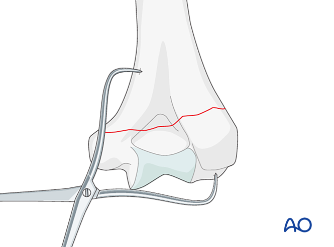 ORIF - Plate fixation for Extraarticular, simple transverse fracture