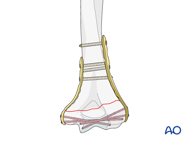ORIF - Plate fixation for Extraarticular, simple transverse fracture