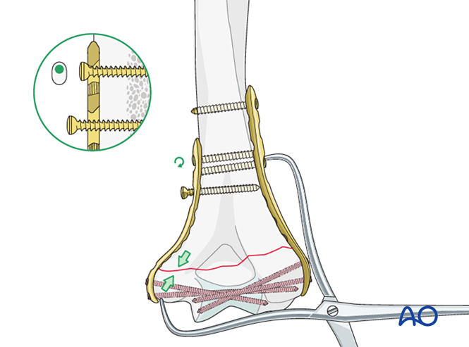 ORIF - Plate fixation for Extraarticular, simple transverse fracture