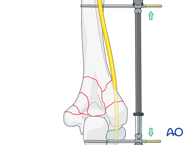 ORIF - Plate fixation for Extraarticular, multifragmentary fracture