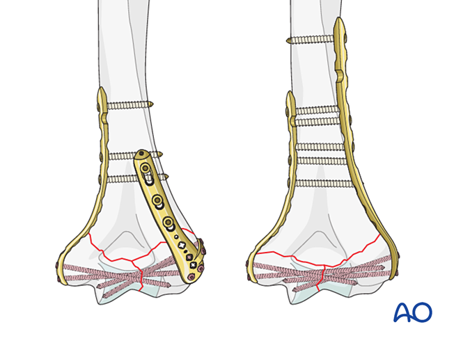 ORIF - Plate fixation for Complete articular fracture, simple articular ...