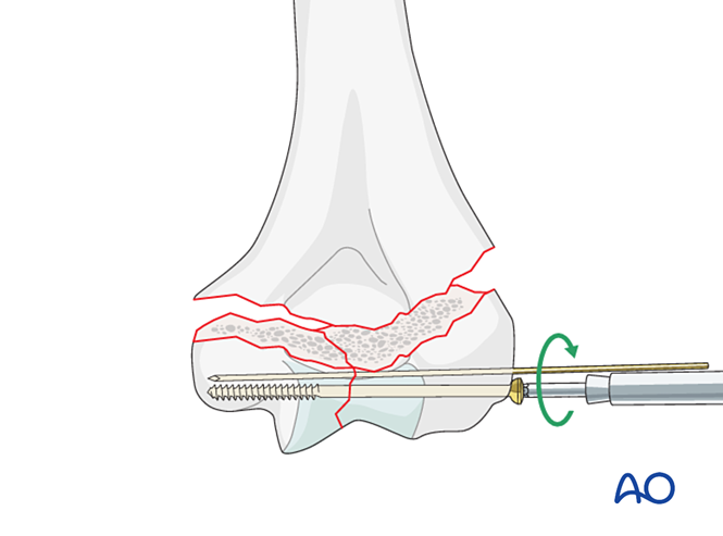 ORIF - Plate fixation for Complete articular fracture, simple articular ...