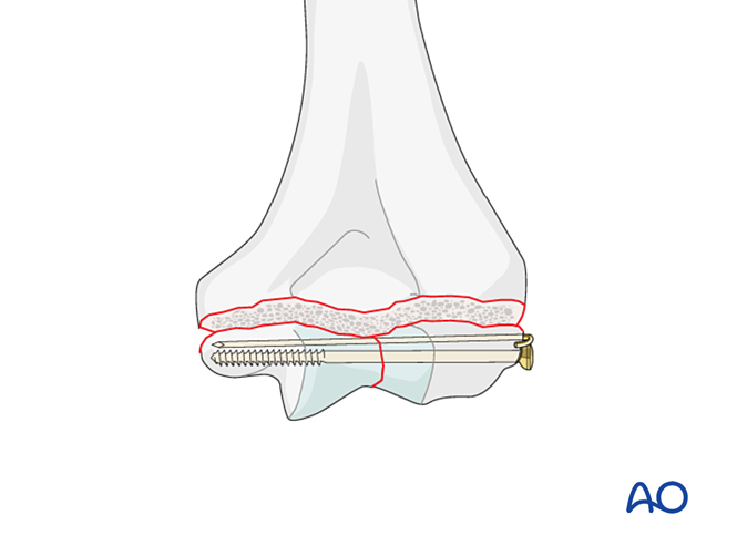 ORIF - Plate fixation for Complete articular fracture, simple articular ...