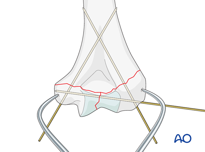 ORIF - Plate fixation for Complete articular fracture, simple articular ...