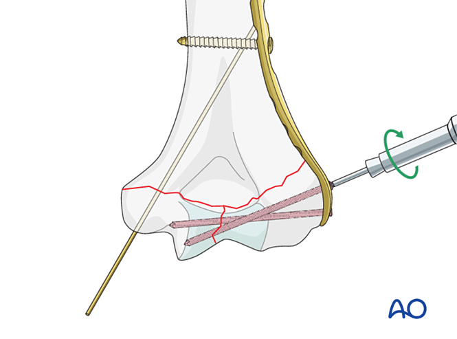 ORIF - Plate fixation for Complete articular fracture, simple articular ...
