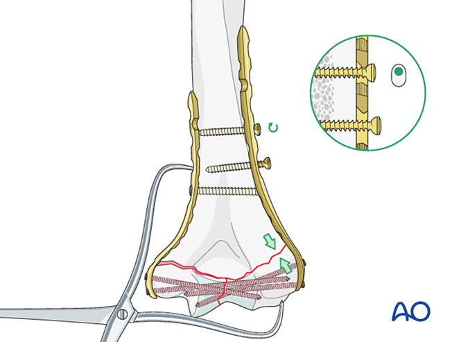 ORIF - Plate fixation for Complete articular fracture, simple articular ...