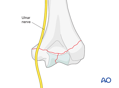 ORIF - Plate fixation for Complete articular fracture, simple articular ...