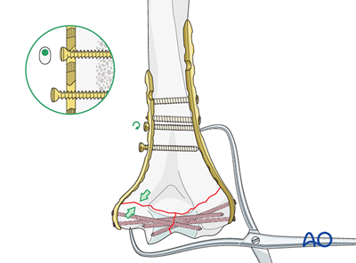 ORIF - Plate fixation for Complete articular fracture, simple articular ...