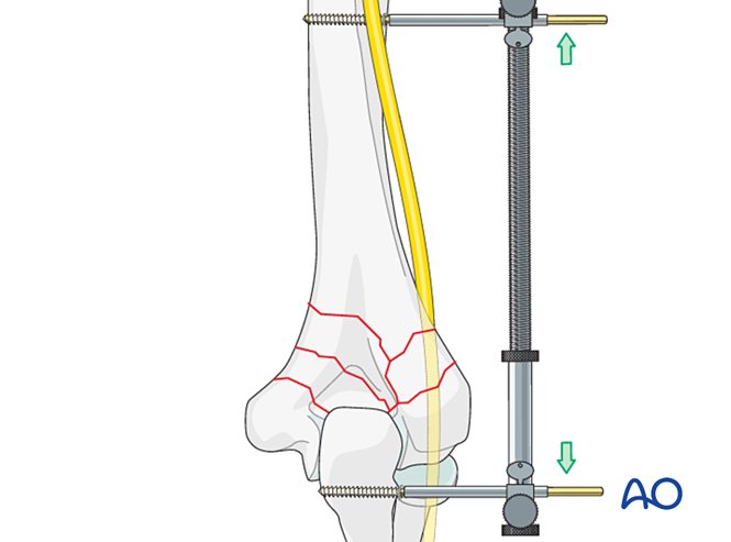ORIF - Plate fixation for Complete articular fracture, simple articular ...