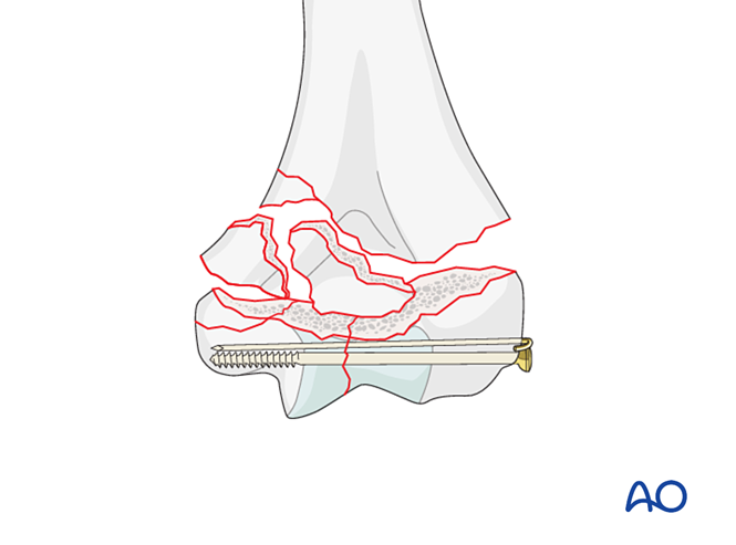 ORIF - Plate fixation for Complete articular fracture, simple articular ...