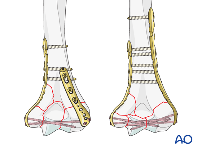 ORIF - Plate fixation for Complete and multifragmentary articular fracture