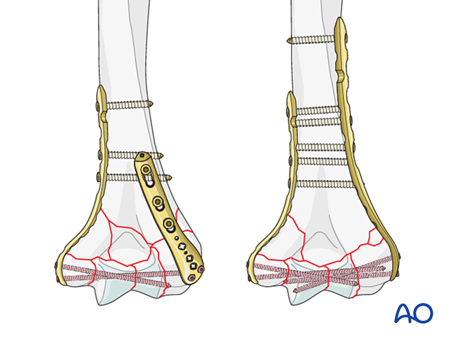ORIF - Plate fixation for Complete and multifragmentary articular fracture