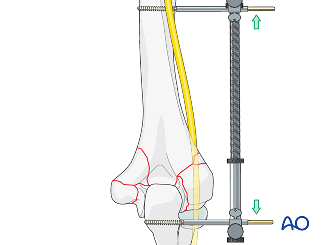 ORIF - Plate fixation for Complete and multifragmentary articular fracture
