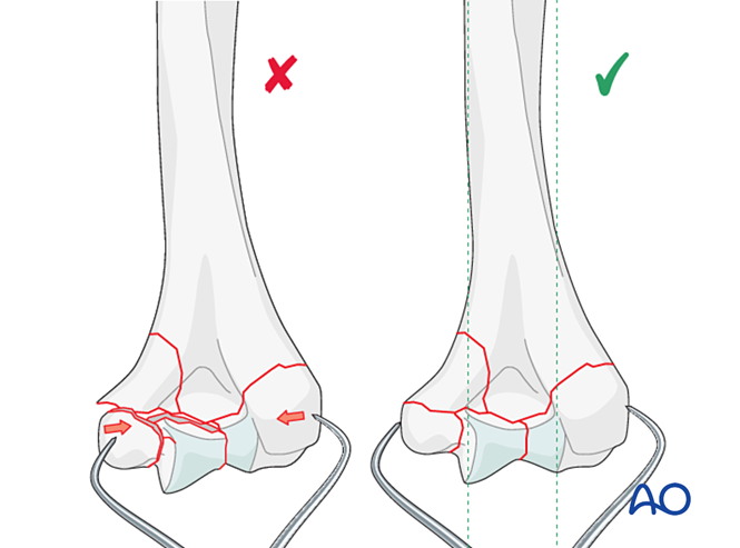 ORIF - Plate fixation for Complete and multifragmentary articular fracture