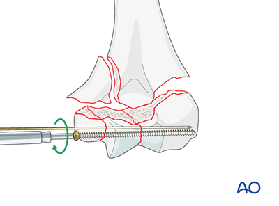 ORIF - Plate fixation for Complete and multifragmentary articular fracture