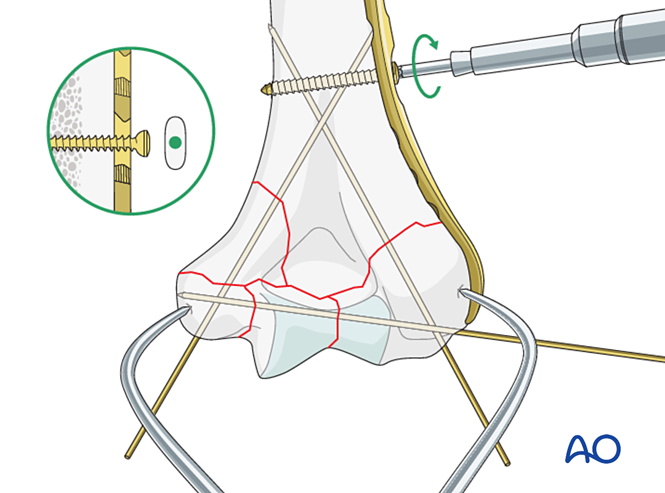 ORIF - Plate fixation for Complete and multifragmentary articular fracture