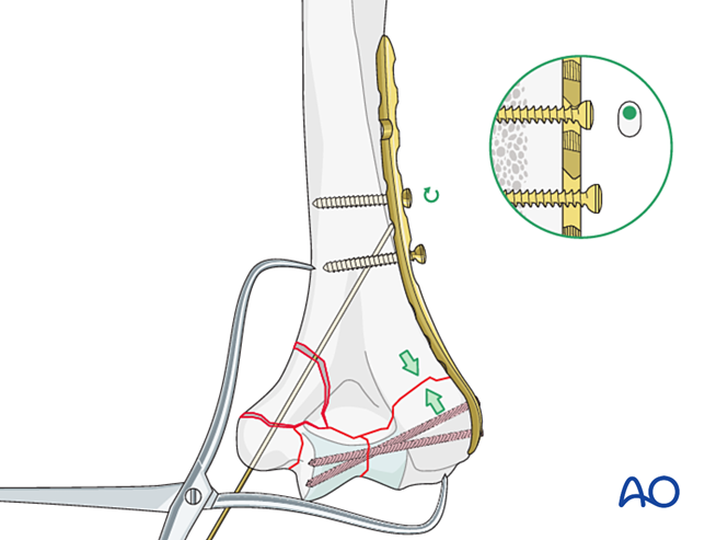 ORIF - Plate fixation for Complete and multifragmentary articular fracture