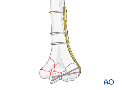 ORIF - Plate fixation for Complete and multifragmentary articular fracture