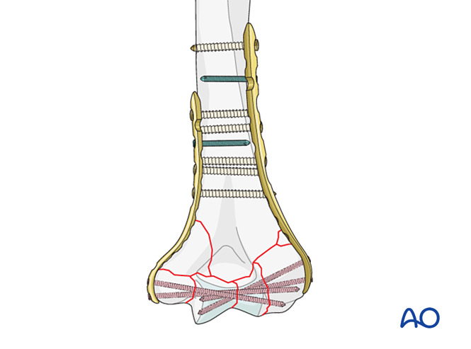 ORIF - Plate fixation for Complete and multifragmentary articular fracture