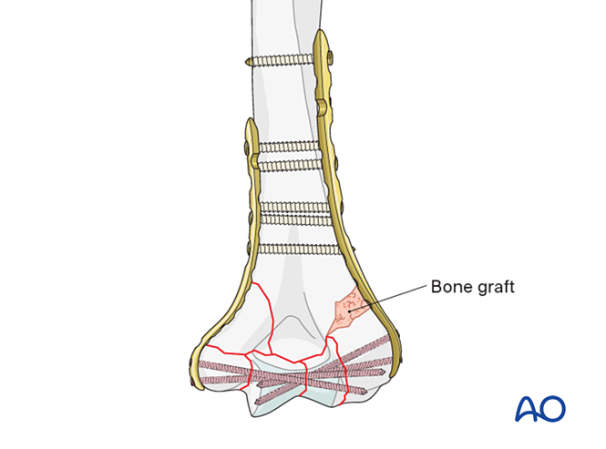 ORIF - Plate fixation for Complete and multifragmentary articular fracture